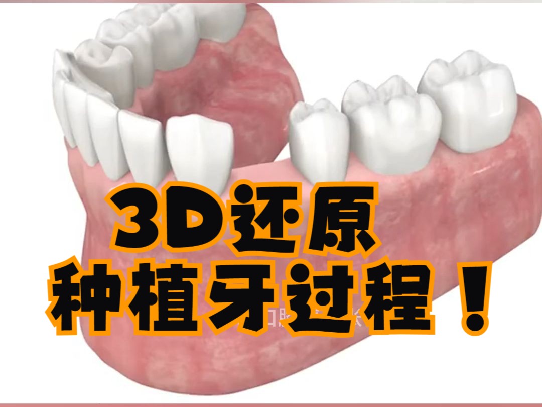 种植牙动画模型演示!让大家对种牙过程一目了然~