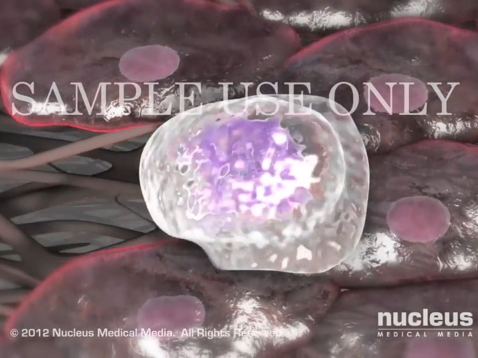 【Nucleus】动脉粥样硬化发病机制的动画视频(中文)