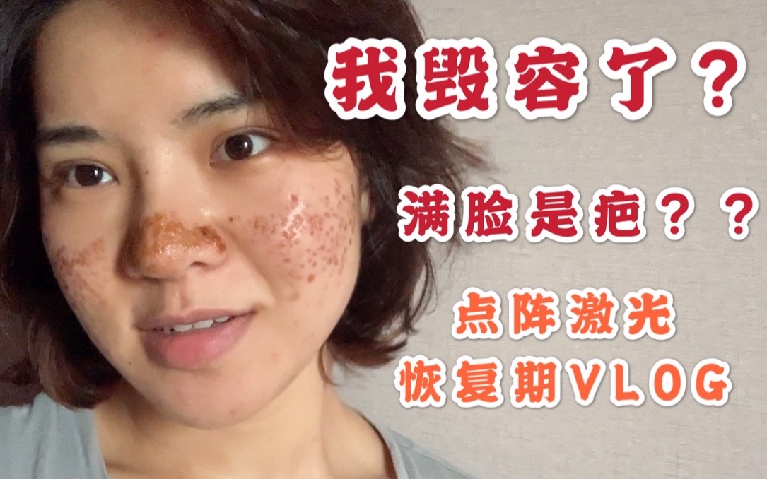 我毁容了?满脸是疤?这还笑得出来?百分百真实的点阵激光的恢复期...