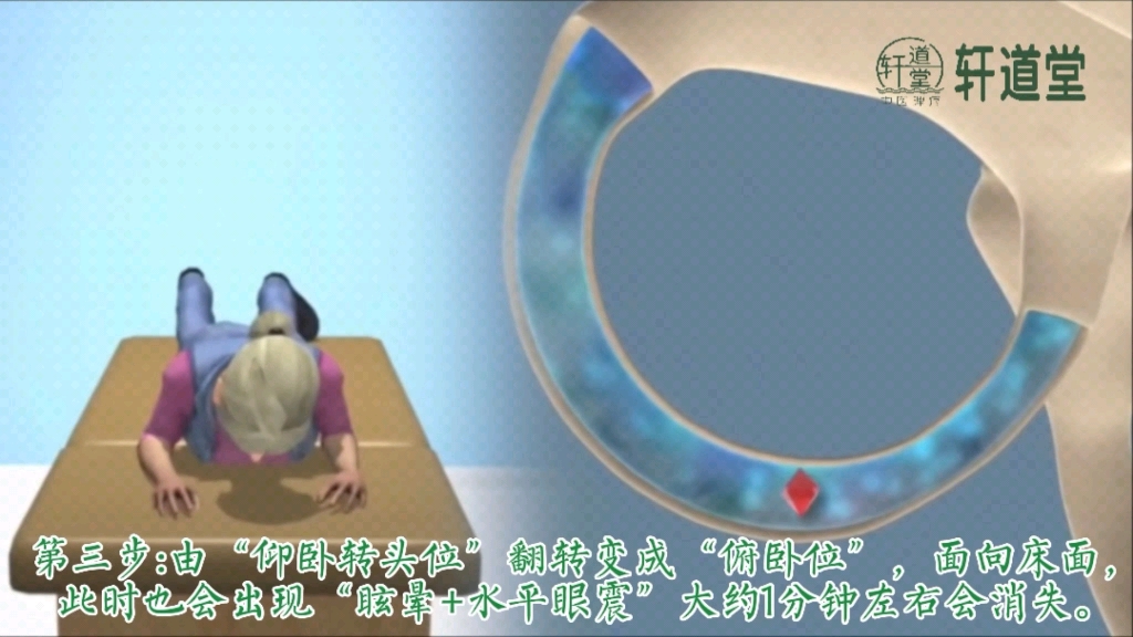 “水平半规管耳石症”的眼震方向+3D动画演示复位方法——赵鹏飞