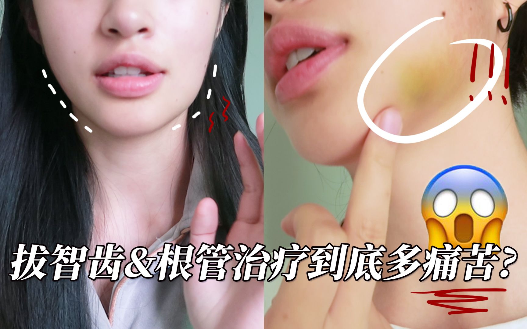 发烧?痛哭?治疗费用?全程记录拔智齿&根管治疗到底有多痛苦