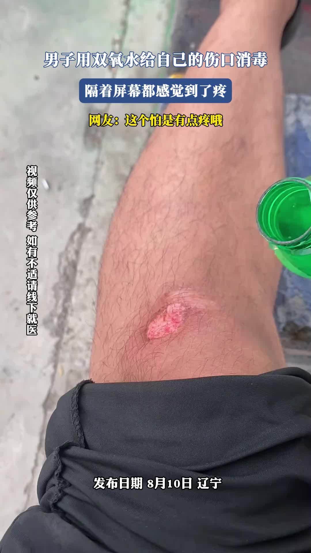 男子用双氧水给自己的伤口消毒,隔着屏幕都感觉到了疼