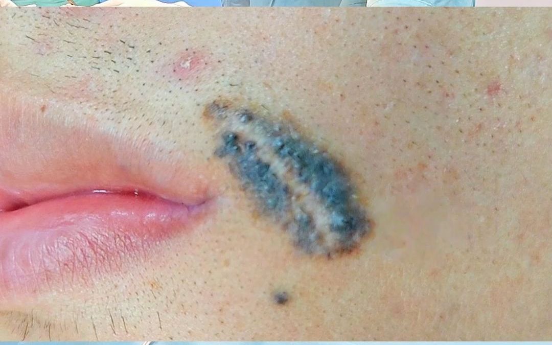 大面积的黑痣,如何去除?