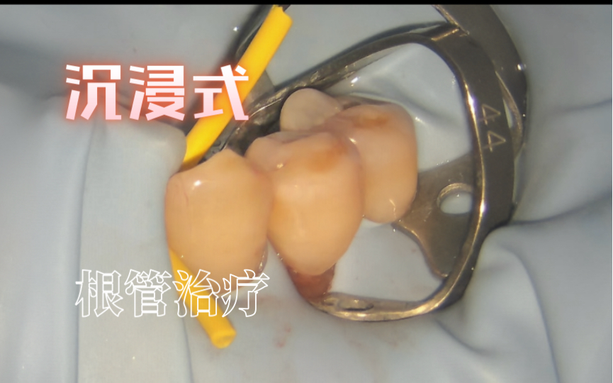 “沉浸式根管治疗”