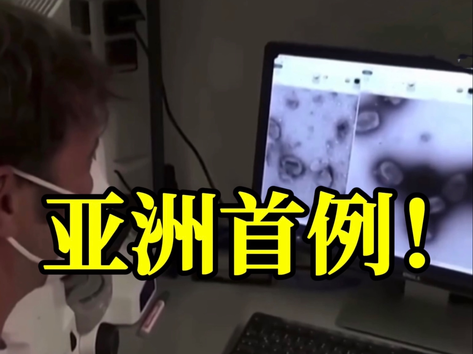 亚洲首例!猴痘变异新毒株出现,可飞沫传播