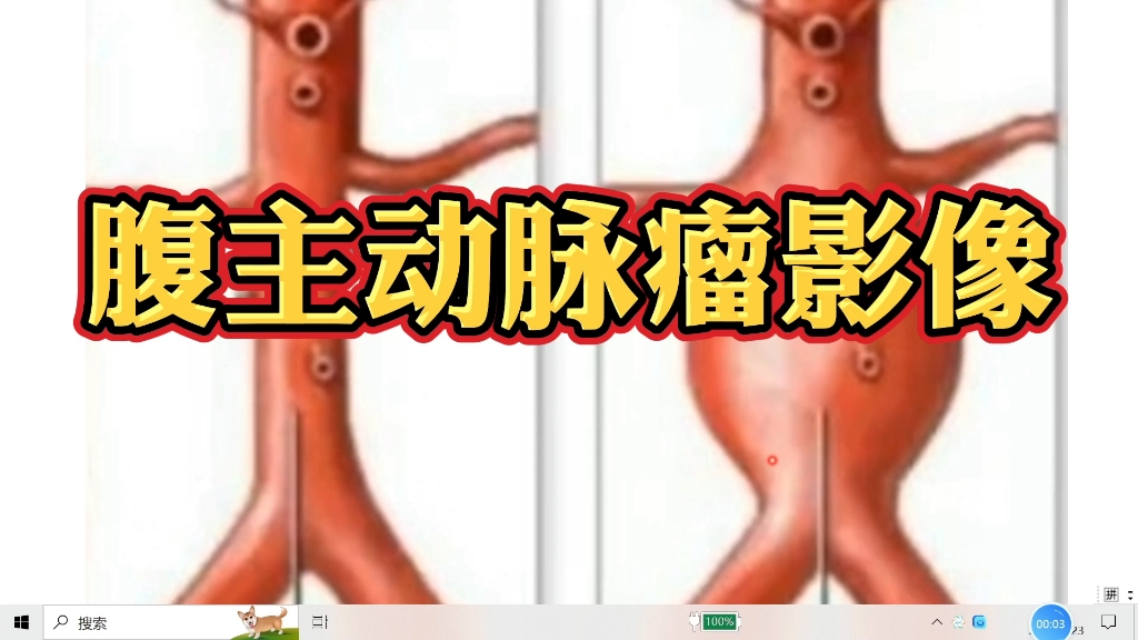病例分享:腹主动脉瘤典型CT表现,诊断标准讲解!