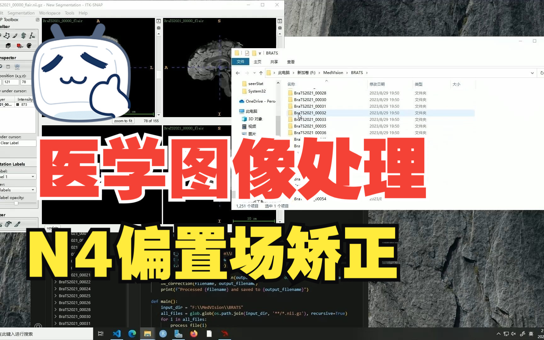 医学图像数据处理N4偏置场矫正