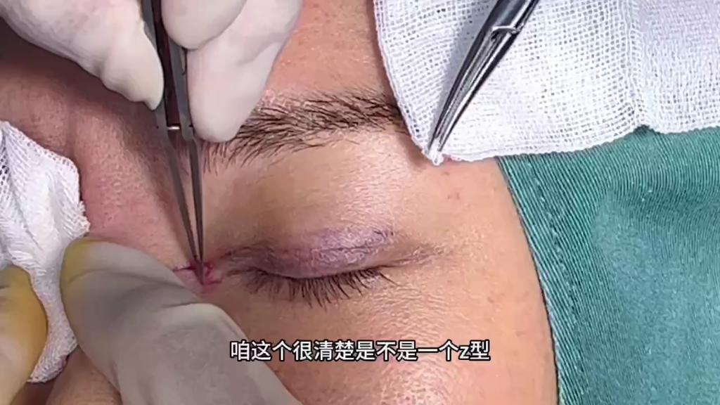 #张旭东医生 #内眦赘皮矫正(开眼角)的经典方法---“Z”成形术