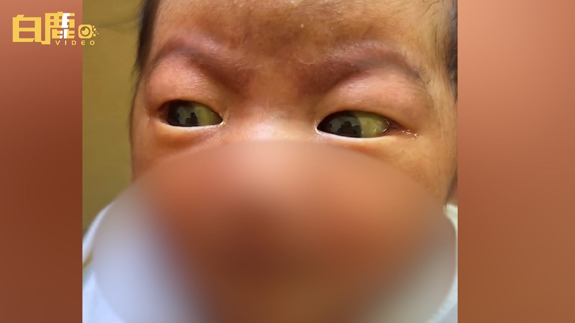 婴儿眼白发黄疑得黄疸引网友担忧