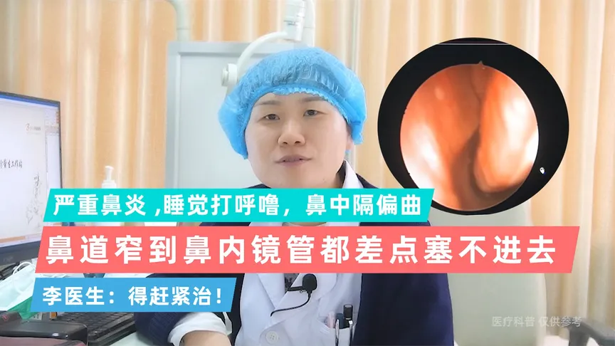 严重鼻炎,睡觉打鼾?原因在这里,电子鼻内镜带你看得明明白白!