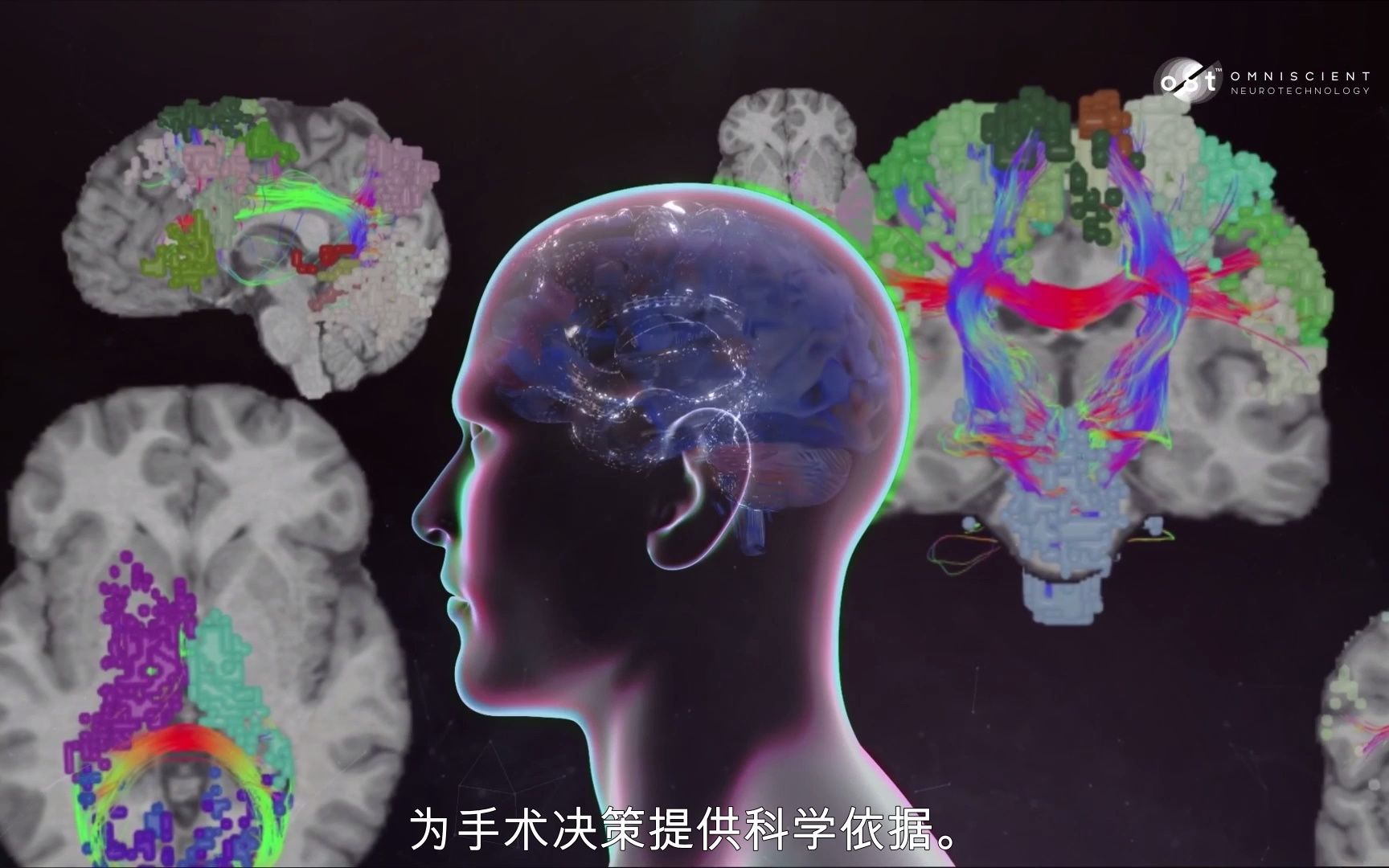 个性化手术计划|Quicktome 神经外科手术计划软件