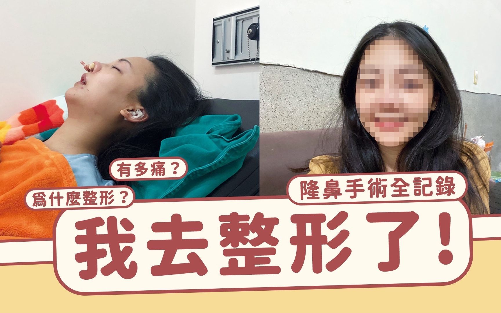 蒜头鼻女生记录隆鼻手术及恢复全过程