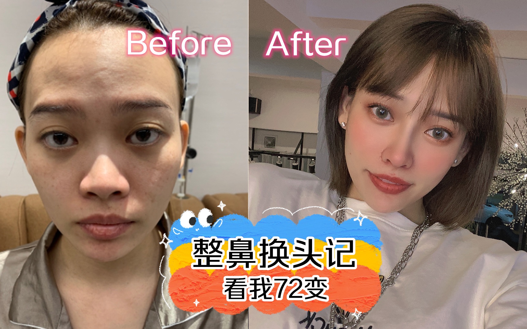 「隆鼻」鼻整形记录vlog &超真实手术前后全过程