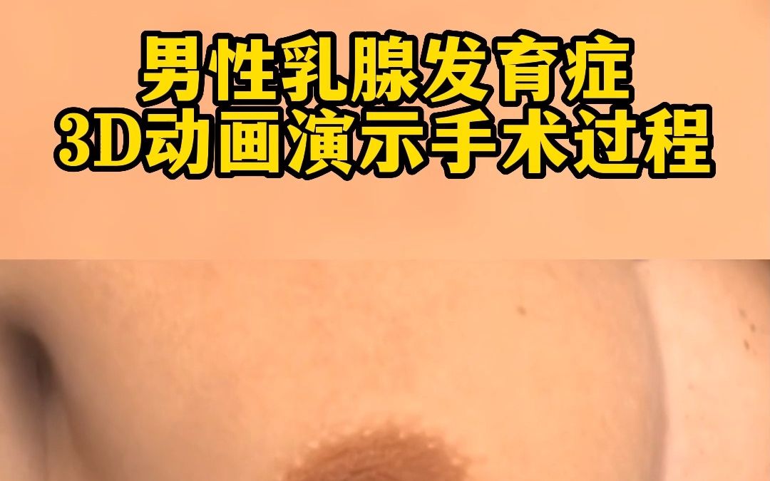 ...动画演示手术过程,微创轻松搞定男性胸部肥大,突出,下垂问题,恢复自信