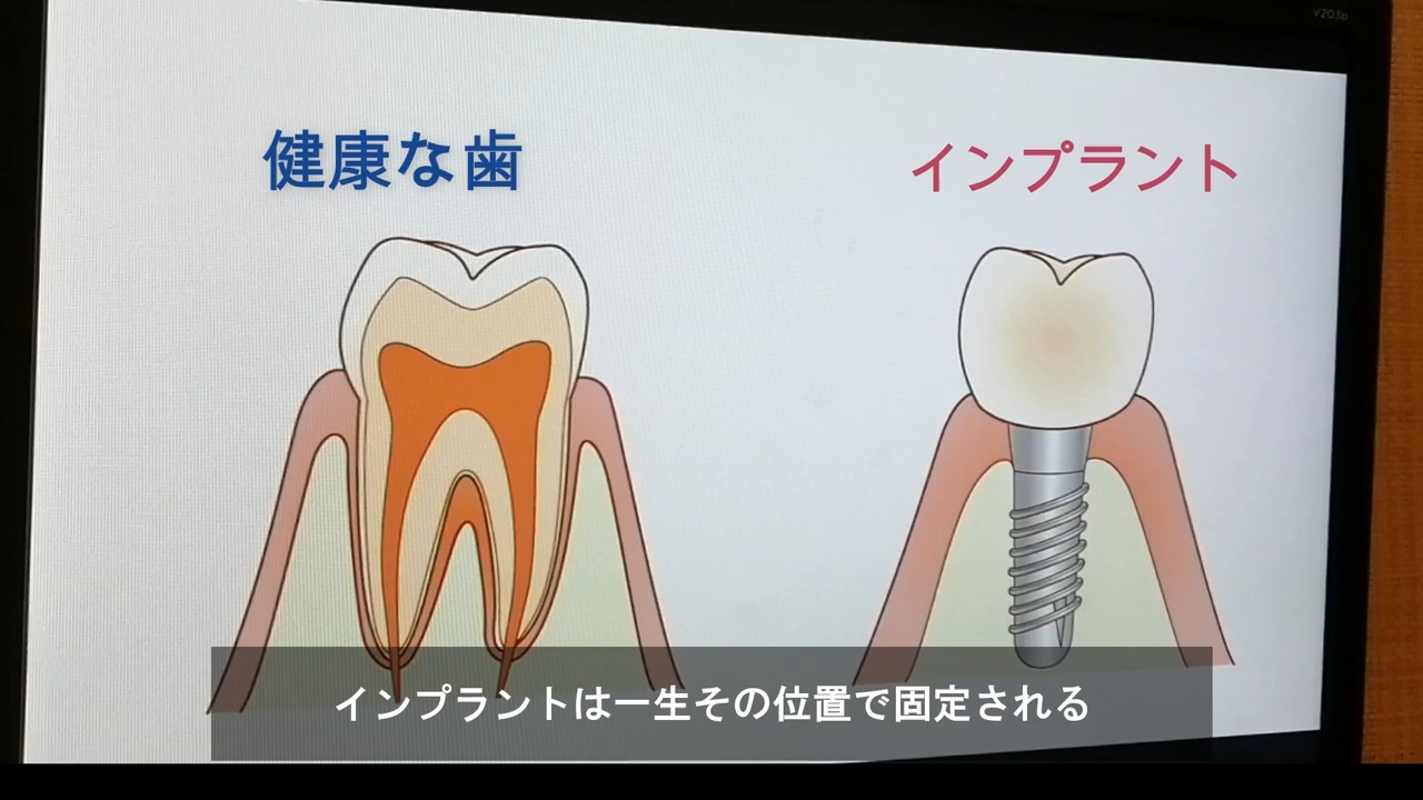 【次世代种植牙!?】牙齿再生医疗