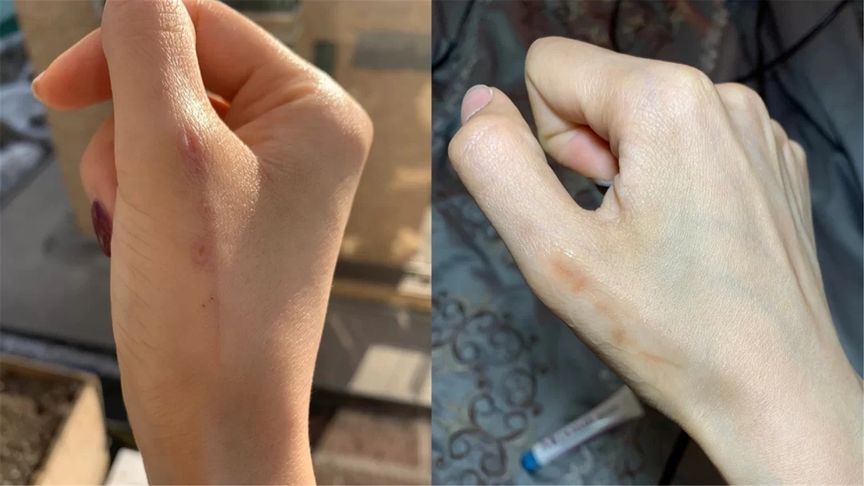 疤痕体质必备祛疤好物!疤克去疤膏轻松一抹疤痕全无!