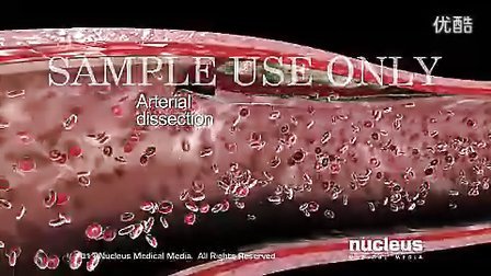 血小板性血栓导致的动脉栓塞-Medical Animation