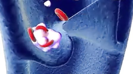 深静脉血栓栓塞的三维医学动画