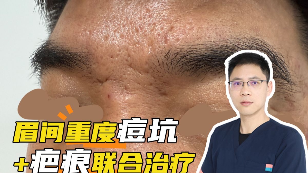 门诊日常:眉间痘坑+疤痕联合修复!