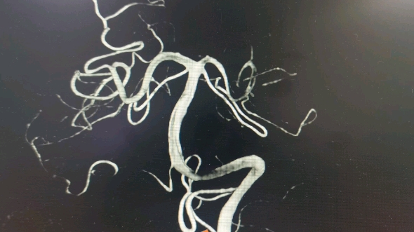 认识小脑后下动脉(PICA),. DSA,脑血管造影,介入科。