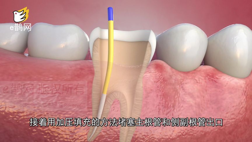 根管治疗,摆脱牙痛,还能保住牙齿