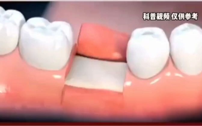 种植牙全过程,了解一下
