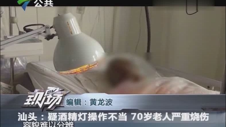 七旬老人酒精灯操作不当,导致全身烧伤严重,好心人送往医院救治