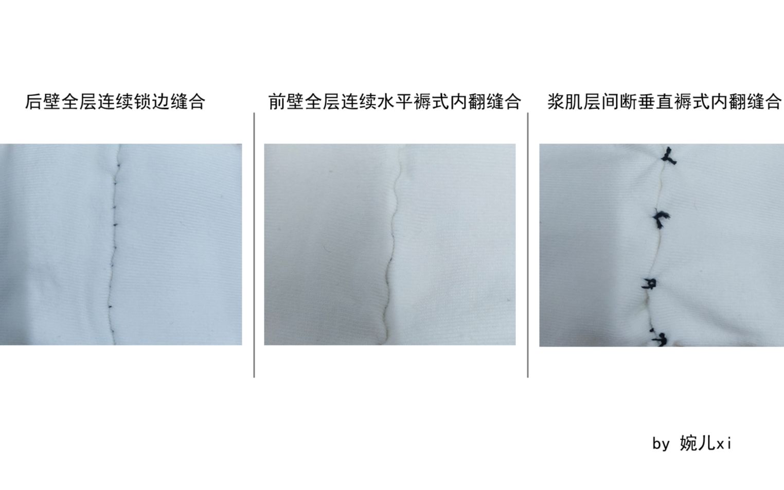 袜子模拟小肠端端吻合术