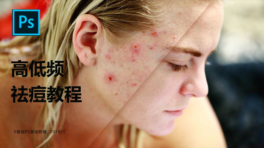 PS祛痘教程 高低频如何快速磨皮处理皮肤瑕疵,祛痘祛红肿痘印