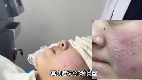 痘坑别用磨砂膏!真皮层损伤修复难,小心毁脸