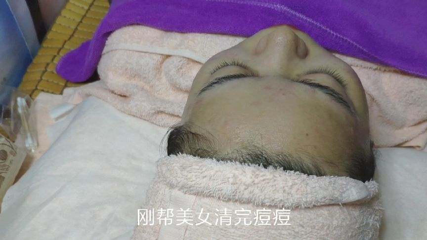 夏天肌肤出油、痘痘反复发作?珍珠粉加海藻面膜,既消炎又去痘印
