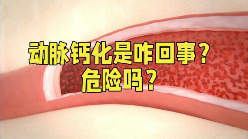 动脉钙化是咋回事?与动脉硬化、动脉粥样硬化有啥不同?