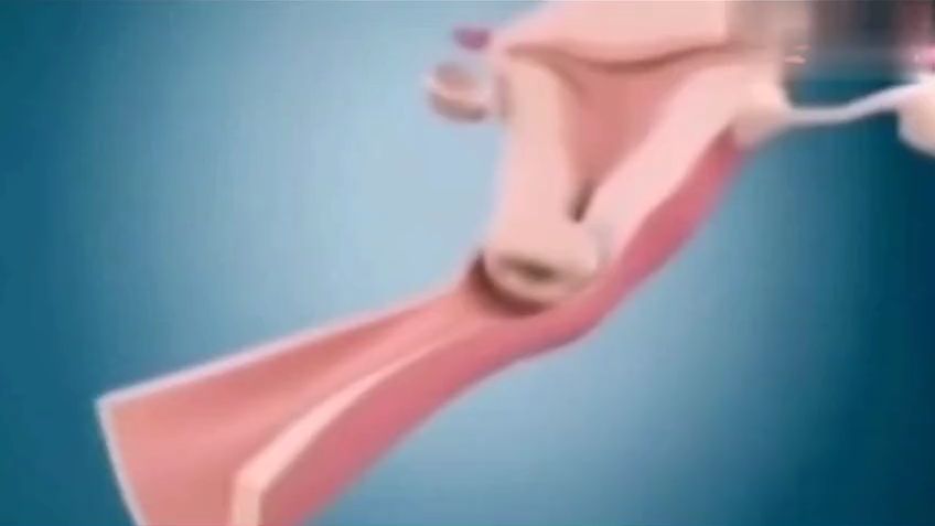 3D医学动画演示女性上环过程,了解更多健康知识。