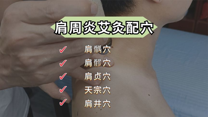 肩周炎艾灸配穴:肩髃穴、肩髎穴、肩贞穴、天宗穴、肩井穴