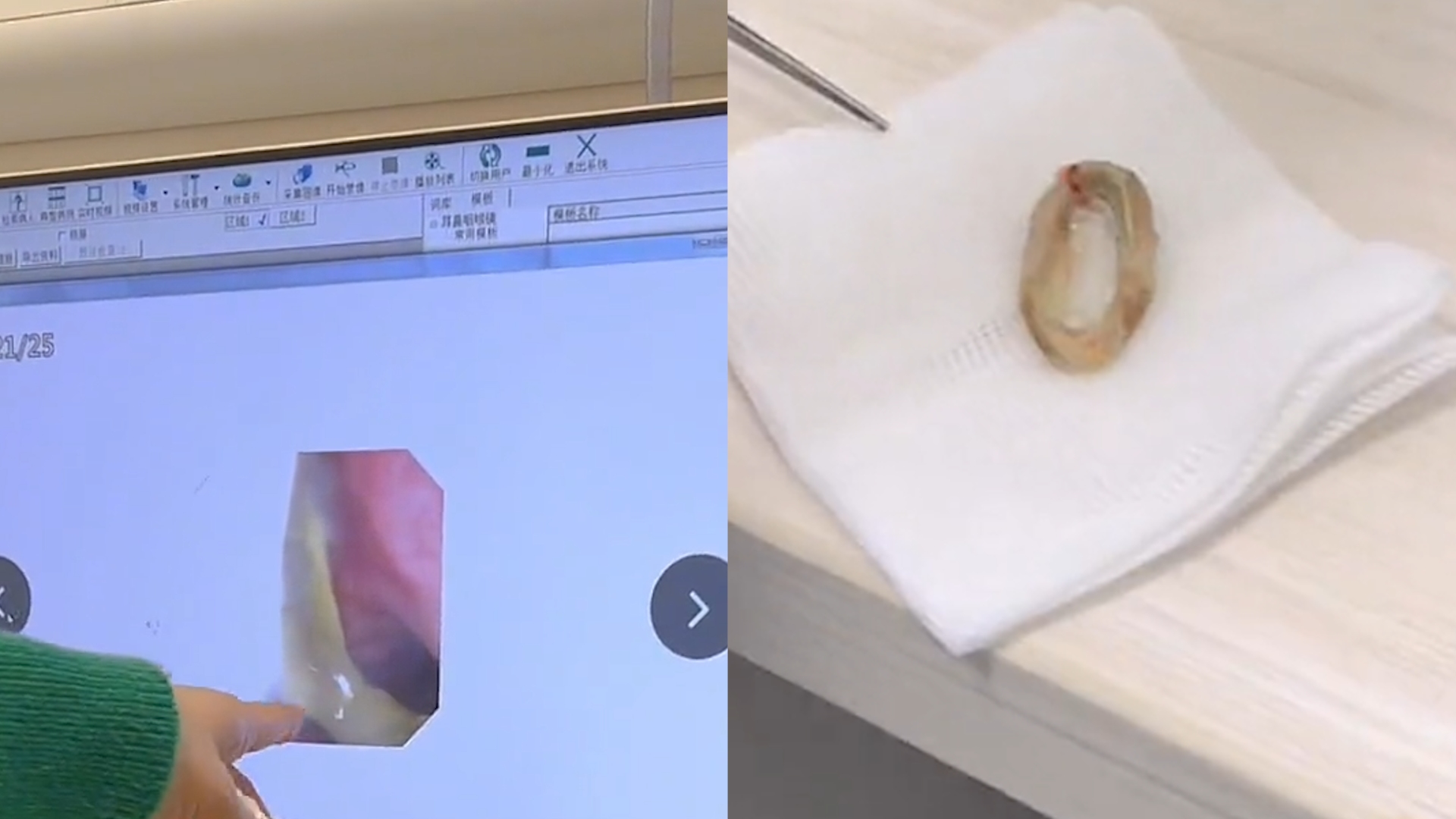 女儿鼻子呼吸有异味长达1年多,到医院检查竟取出皮筋,妈妈自责