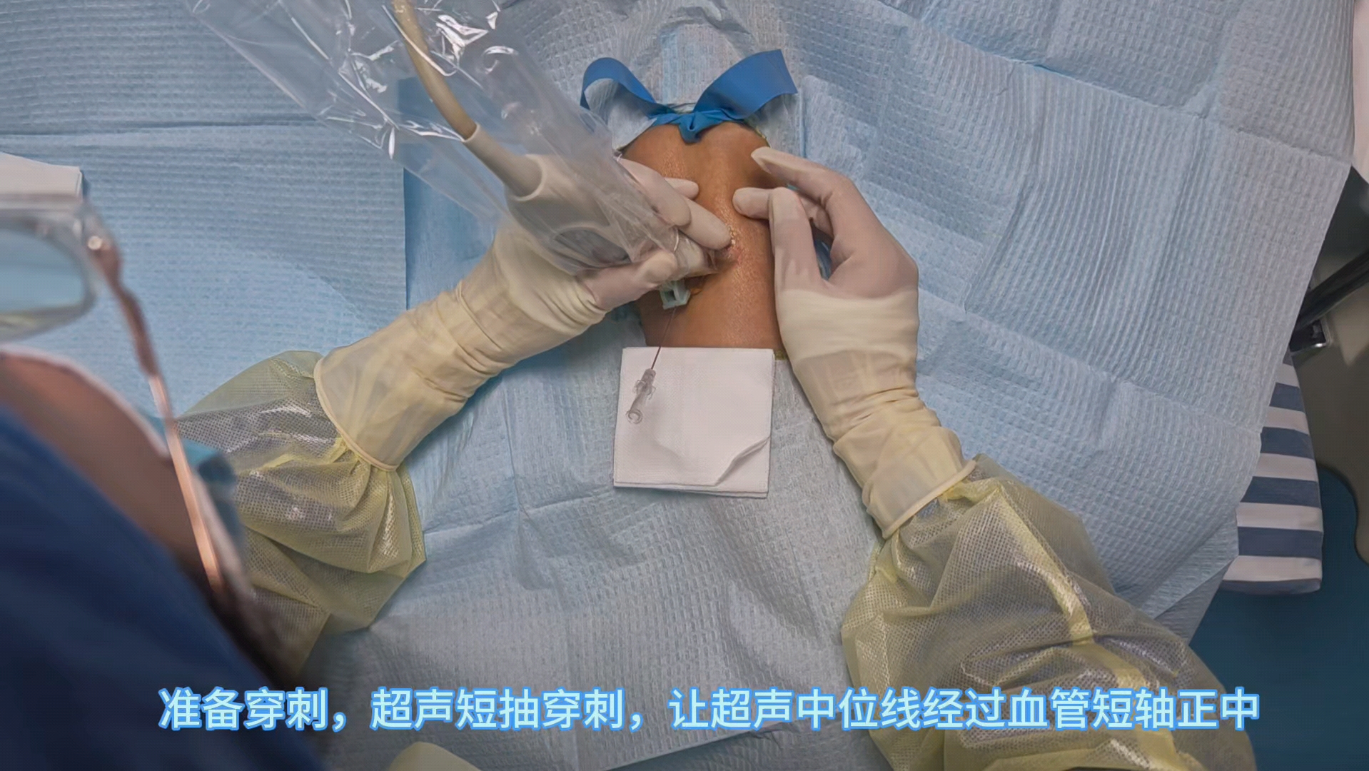 PICC导管置入。2000多的PICC全是毛病,500多的PICC都是优点,一样...