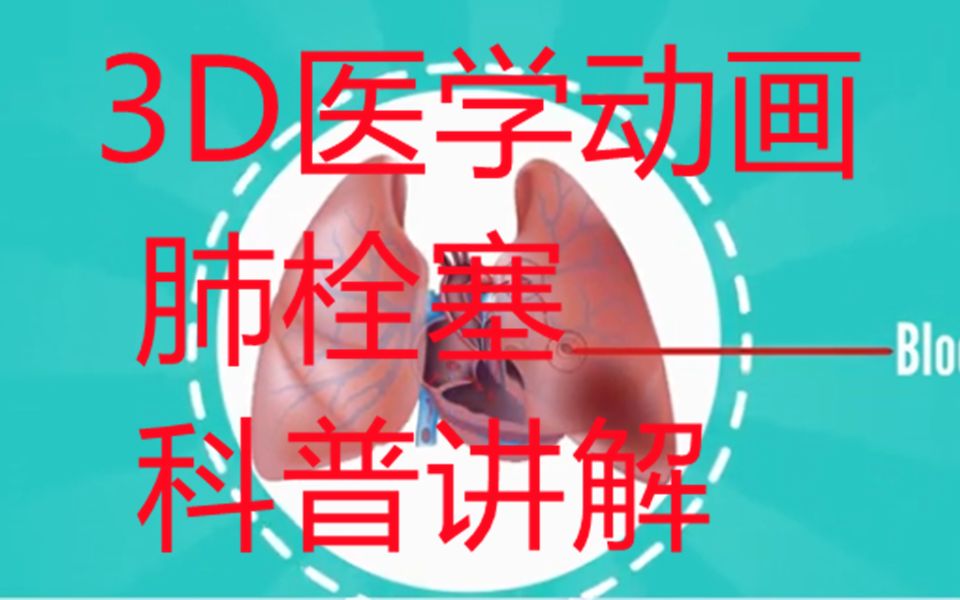 肺栓塞科普讲解-3D医学动画