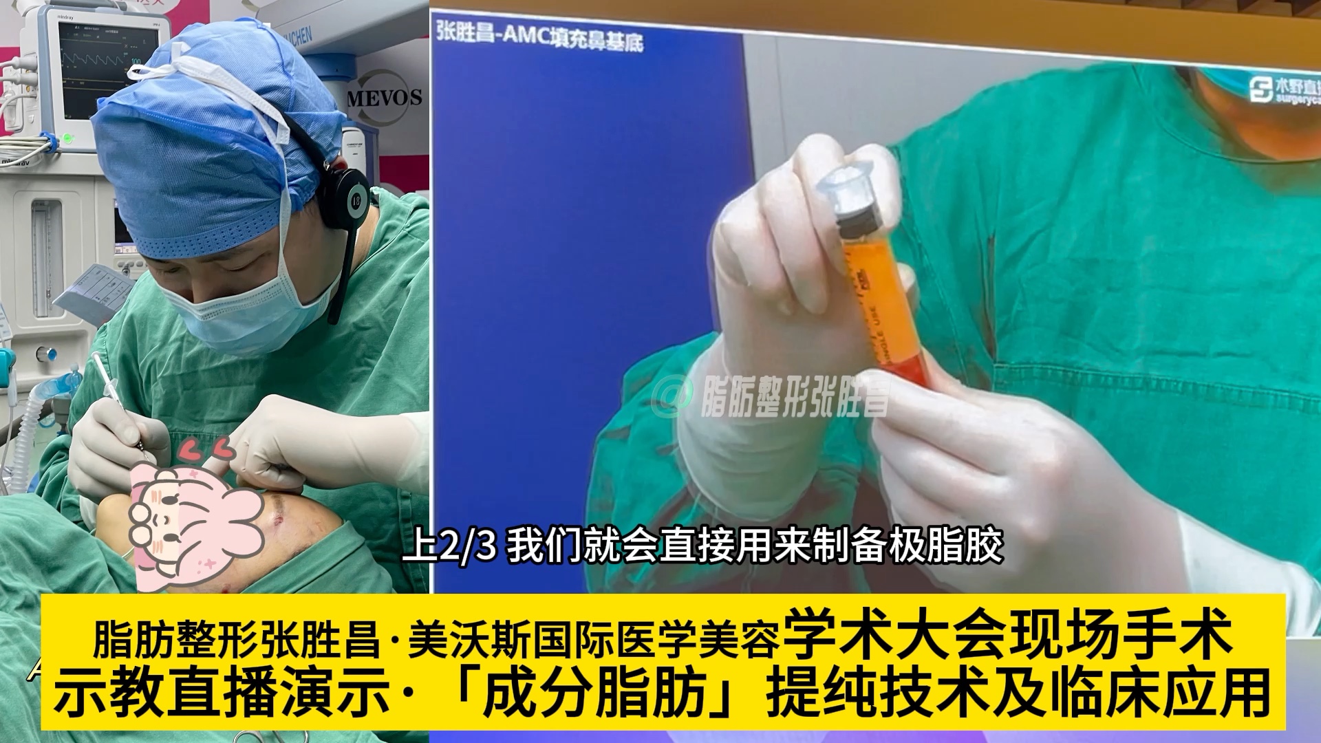 脂肪整形/移植张胜昌学术大会现场演示:什么是「成分脂肪」?