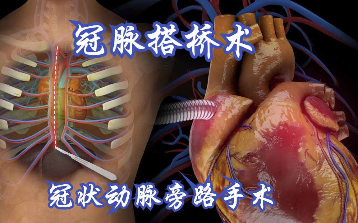 冠脉搭桥术