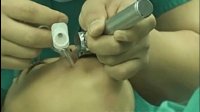 医看医学影像: 临床手术技能20 02第二集气管插管术