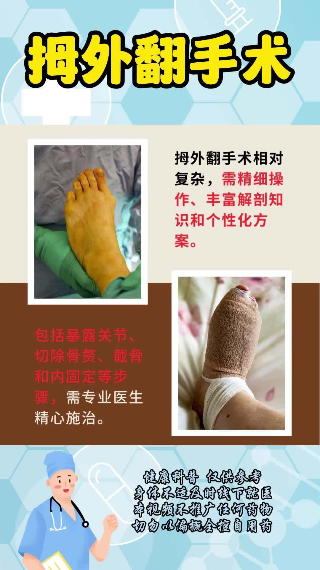 拇外翻手术:复杂还是简单?一探究竟!