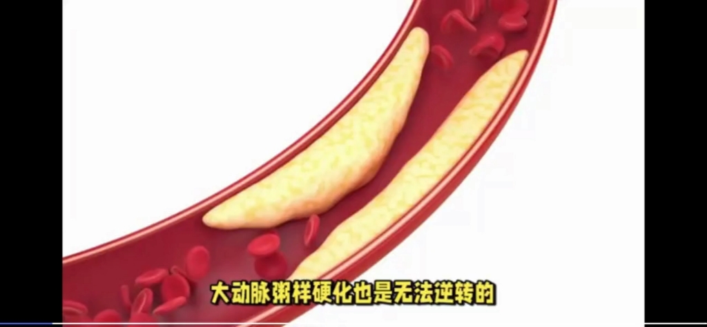 怎样才能把血管壁上的垃圾(斑块之类的)清除或减轻?大动脉粥样硬化...