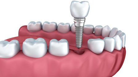 假牙是如何被种在牙床上的?3D动画还原全过程,隔着屏幕都疼