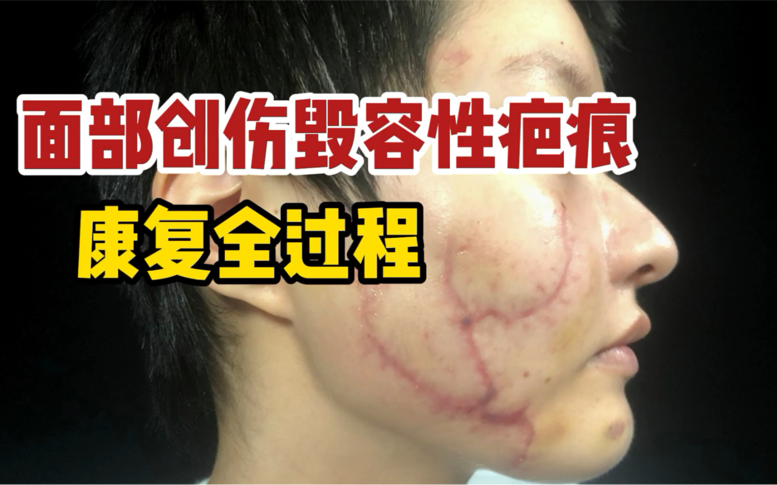 面部毁容性疤痕,修复后效果惊艳!
