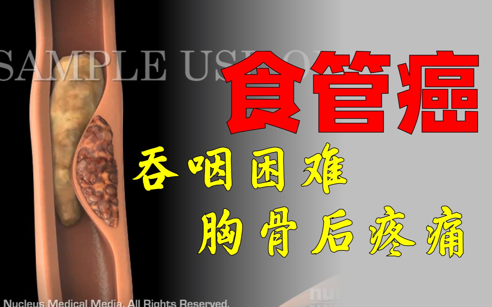 【3D医学动画】食管癌(中英双字幕)