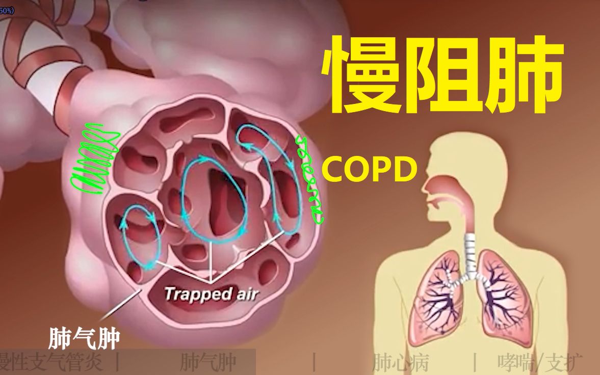 【病理三分钟】慢阻肺:慢支/肺气肿/肺心病/哮喘/支扩,你分清楚了吗? (...