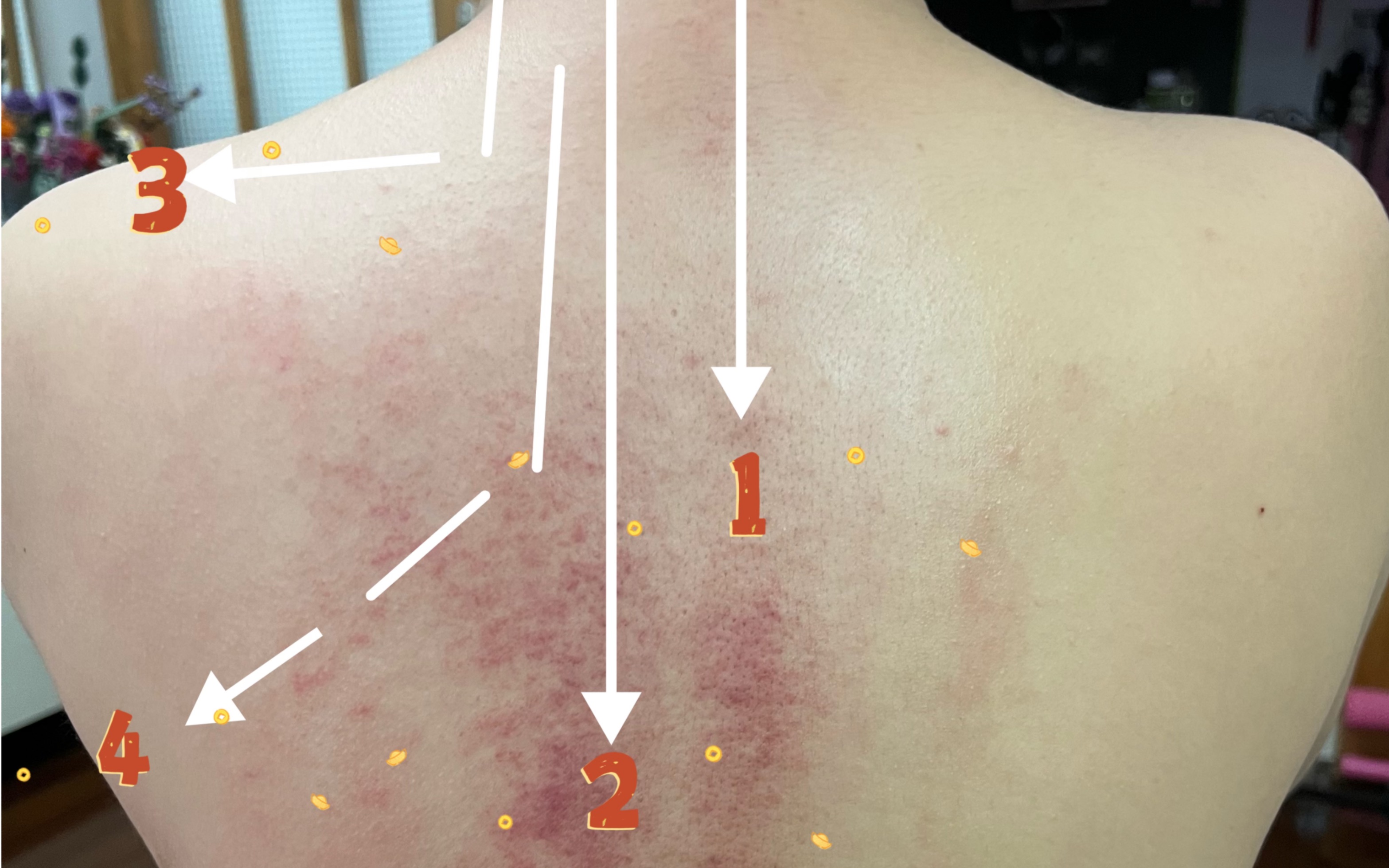 孩子咳嗽,脾胃不好,肩颈疼痛来定期无痛刮痧