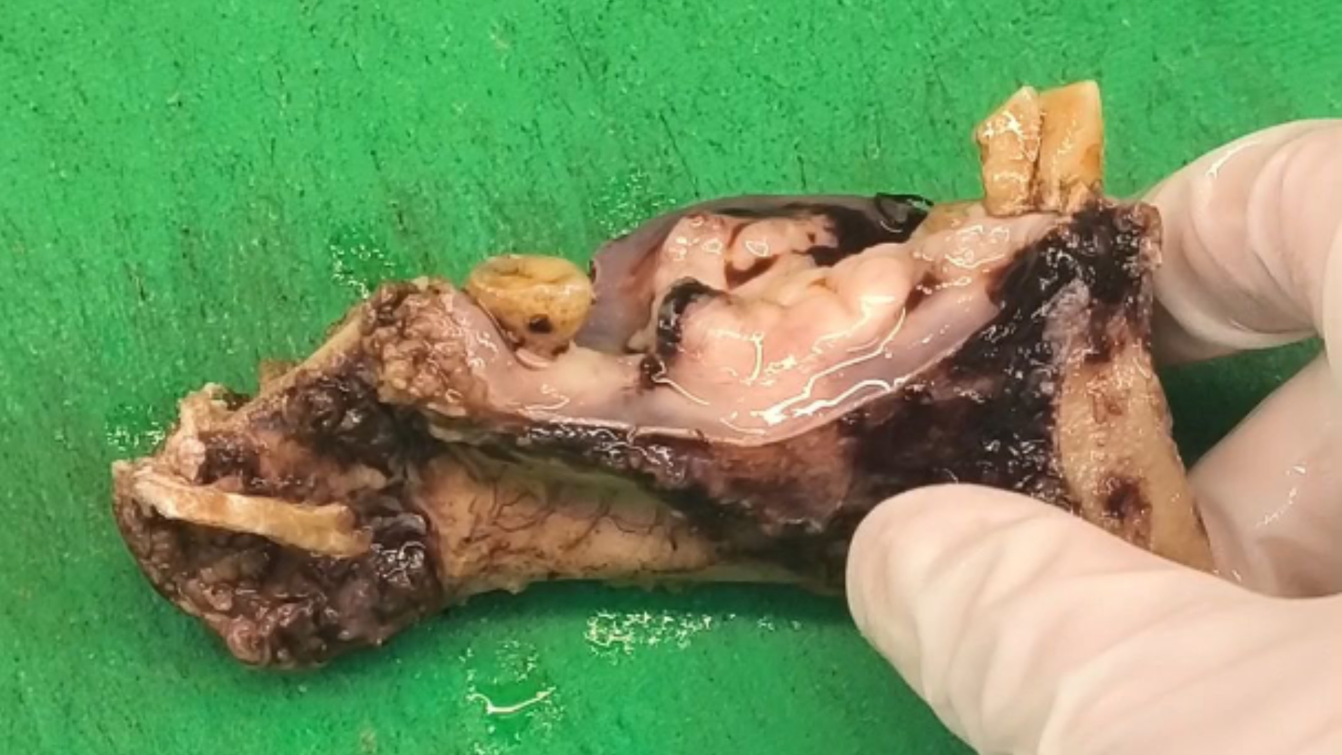 牙龈癌!牙龈出现溃疡或肿块,疼痛剧烈,长期不愈合,触之容易出现出血,...