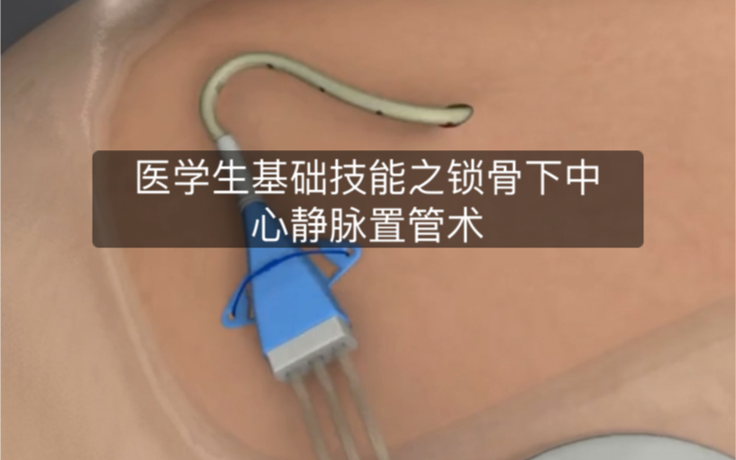 适合医学生反复观看并熟记的技能之锁骨下中心静脉置管术
