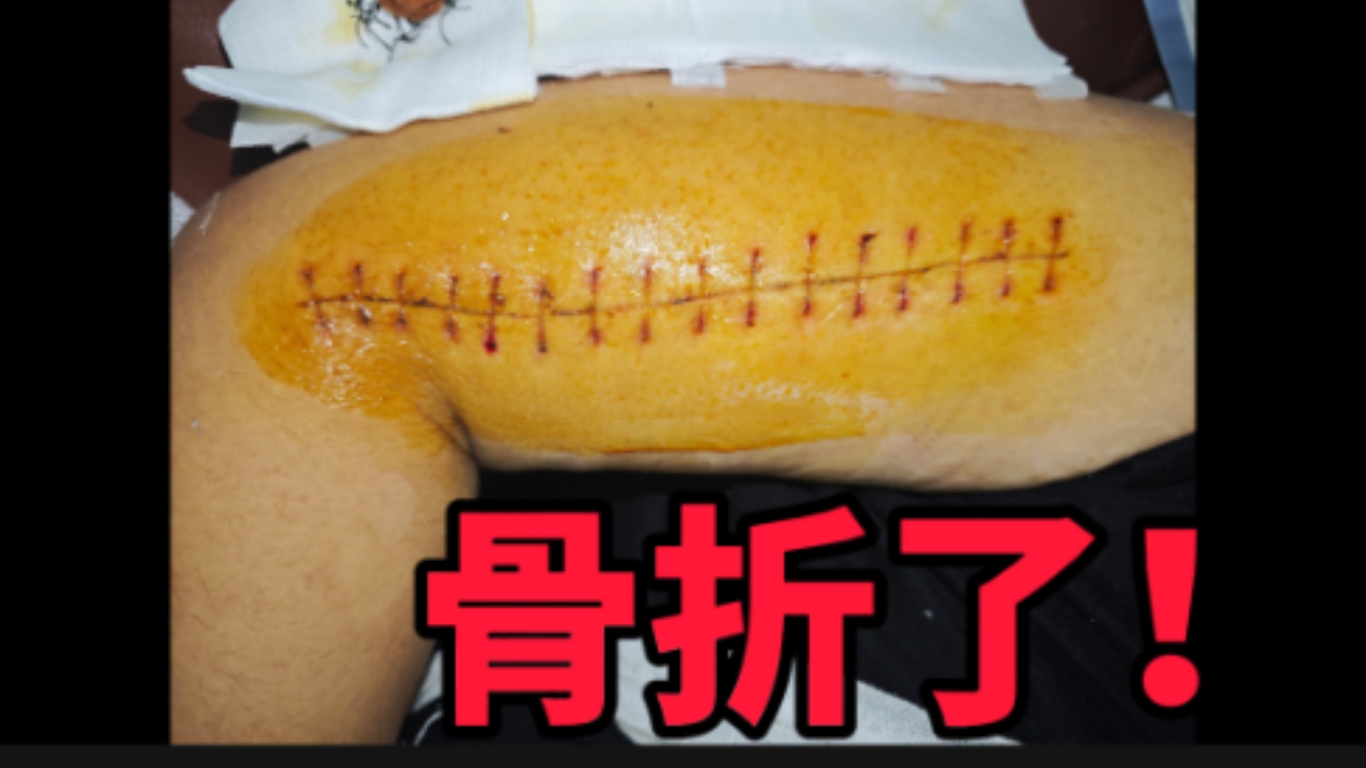 在骨头上钻了九个洞!缝了二十针!插尿管!骨折的真实经历!